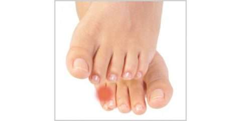 Lesser Toe Deformities | APM