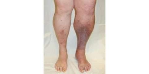 Peripheral Venous (Vein) Disease | APM